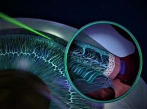 Selective laser trabeculoplasty (SLT) - VisionClinic